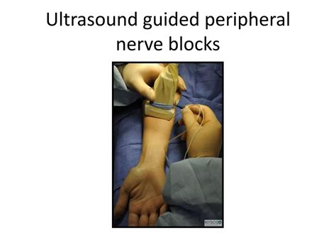 Upper Limb Blocks Ppt