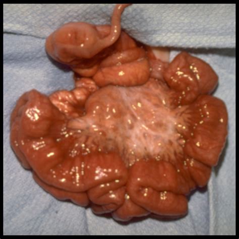 Infant With Bilious Vomiting Pediatric Radiology Case Pediatric