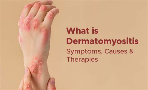 What Is Dermatomyositis Symptoms Causes And Therapies