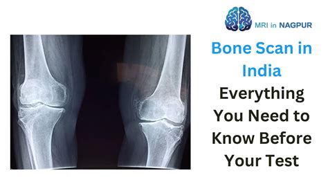 Bone Scan Guide Save ₹3000 On Your Next Test In Nagpur Nagpur Mri Scan