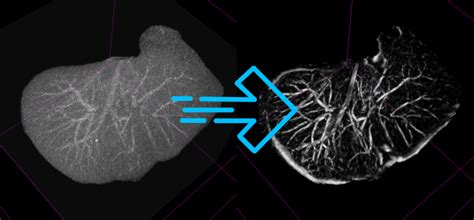 3d slicer s liver segmentation a look at the new features