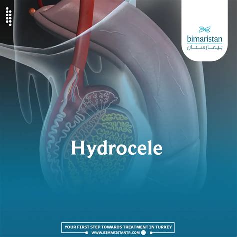 Hydrocele Symptoms And Its Treatment In Turkey Bimaristan