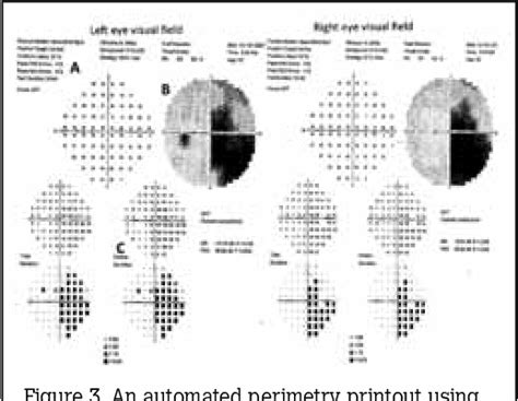Figure 3 From Visual Field Defects After Stroke A Practical Guide For Gps Semantic Scholar