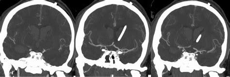 Pcom Rupture With Ivh