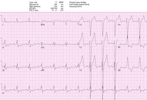 Lbbb And Occlusion Mi Ecg Cases Emergency Medicine Cases
