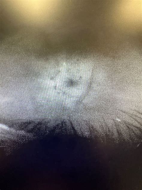 Charles Mayron Md Facs On Linkedin Amazing Xipere Occlusiveretinalvasculitis