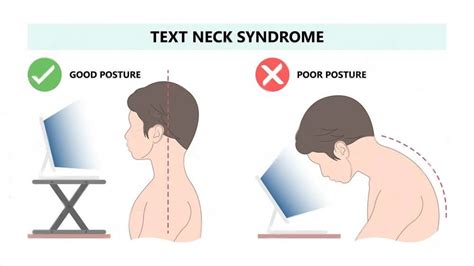 Turtle Neck Syndrome Exercises Causes And Symptoms Vaunte