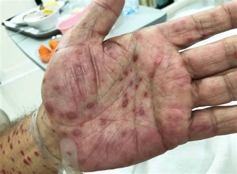 ชมรมแพทย์ชนบท ทำความรู้จักโรคซิฟิลิส ซิฟิลิส มีสาเหตุจากอะไร ซิฟิลิส Syphilis เป็น