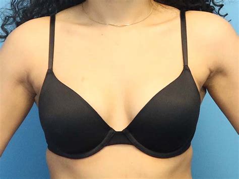 32dd Breast Augmentation