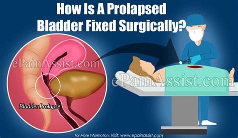 Mild Prolapsed Bladder
