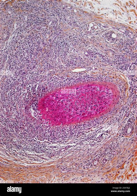 Polyarteritis Nodosa Necrotizing Vasculitis Light Micrograph Of A