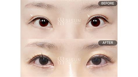 [banda] 라인낮추기 두줄따기 2년8개월 경과｜절개눈매교정 재수술 윗트임 재수술 2년8개월 Youtube