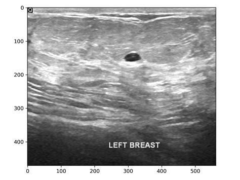 Github Aijared Breast Cancer Detection A Deep Learning Project Of Breast Cancer Detection
