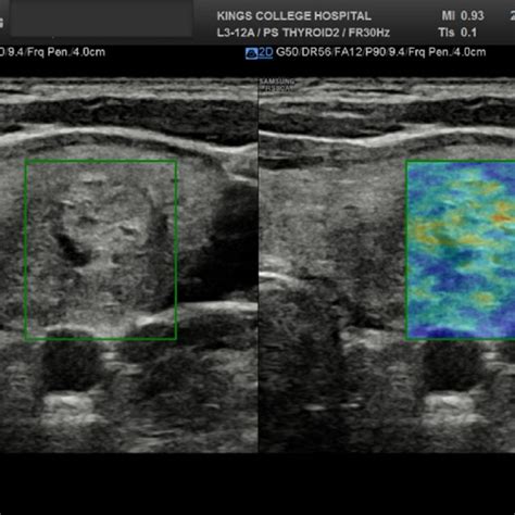 Benign Nodule This Hyper Echoic Lesion In The Right Lobe Of The Download Scientific Diagram