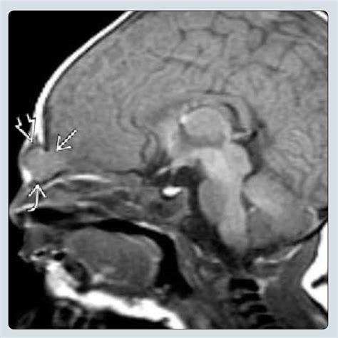 Frontoethmoidal Cephalocele Otolaryngology Secrets