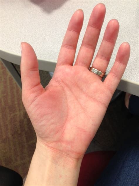 Strep Throat Rash On Hands Strep Throat Rash On Hands