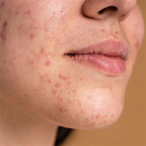 Toothpaste On Pimple Does It Work Or Cause Harm Dermatologist Explains