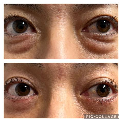 Lower Bleph Pre And One Week Post Rplasticsurgery