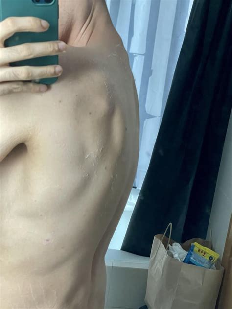 Using Selenium Sulfide To Heal My Fungal Acne At Back Is It Normal To Peel Instruction Says