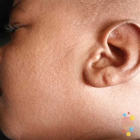 Scabies Rash On Face