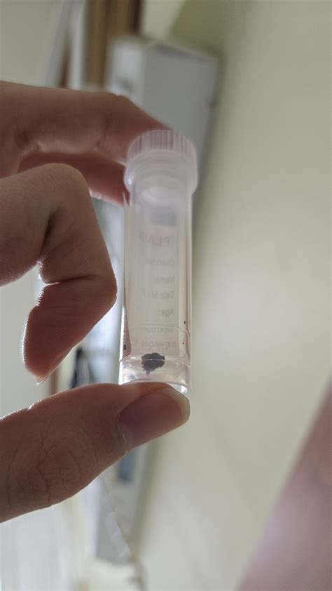 4개월전 요로결석으로 고생햇던 현재근황 포텐 터짐 최신순 에펨코리아