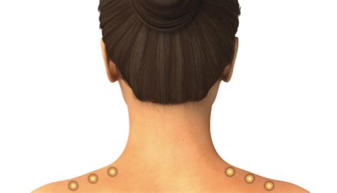 Chronic Migraine Dosing And Administration Botox One® Botox® Onabotulinumtoxina