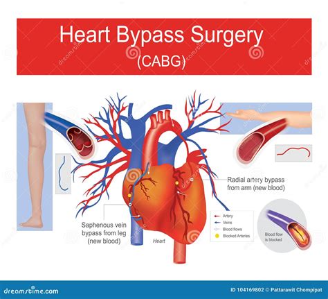 Bypass Heart Stock Illustrations 591 Bypass Heart Stock Illustrations