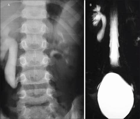 The Intravenous Urography A And Magnetic Resonance Urogram B Download Scientific Diagram