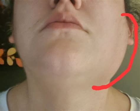 Swollen Lymph Node For 2 Months R Lymphnodes