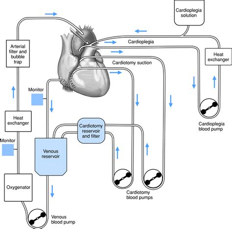 Cardiopulmonary Bypass Machine Diagram