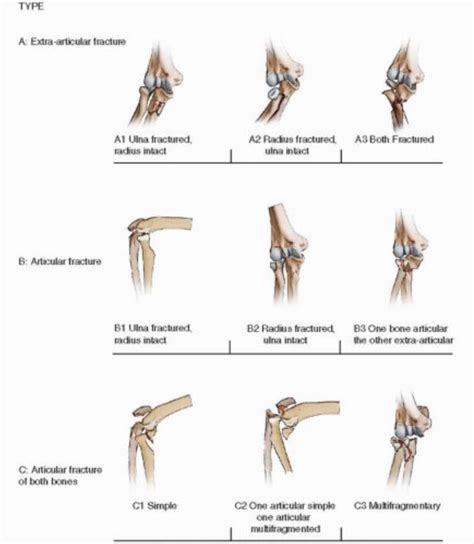 Olecranon Fracture Classification