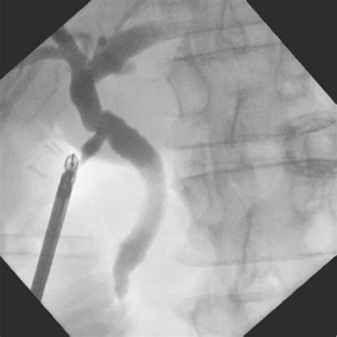 Pre Exploration Cholangiogram Download Scientific Diagram