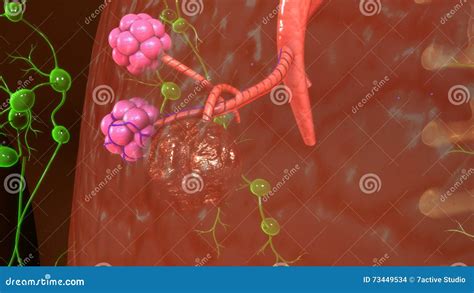 Lungs Granuloma Stock Illustration Illustration Of Bloodvessels 73449534
