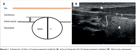 Figure 1 From Extra Thyroid Extension Prediction By Ultrasound