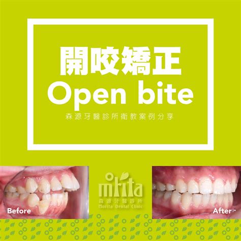 開咬 Open Bite