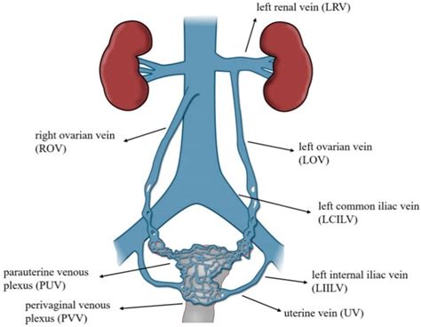 Hemodynamic And Radiological Classification Of Ovarian Veins System Insufficiency