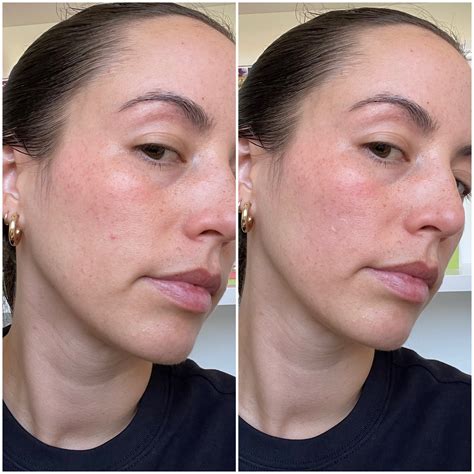 Rael Ultimate Pimple Patch Kit Review With Photos Popsugar Beauty