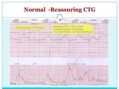Ctg Interpretation And Management Pdf Pregnancy Reproductive Health