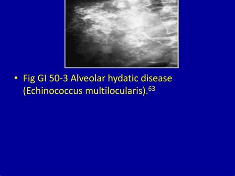 50 Liver Calcification Pptx