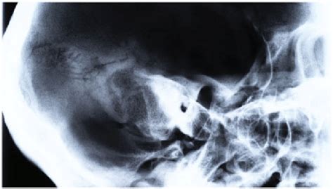 Temporal Bone With Poor Pneumatization Download Scientific Diagram