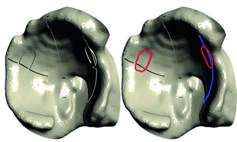 Patient Specific Instrumentation Improves The Accuracy Of Acetabular Component Placement In