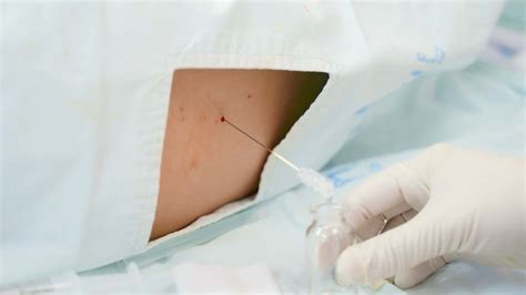 Lumbalpunktion Ablauf Risiken Nebenwirkungen Und Tipps