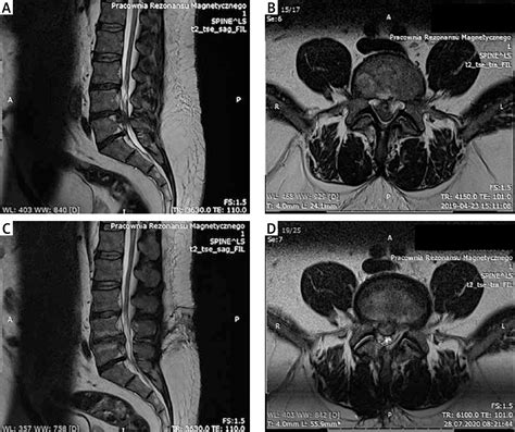 Reoperation Rate After Fusion And Non Fusion Surgery For Degenerative Lumbar Spine Disease