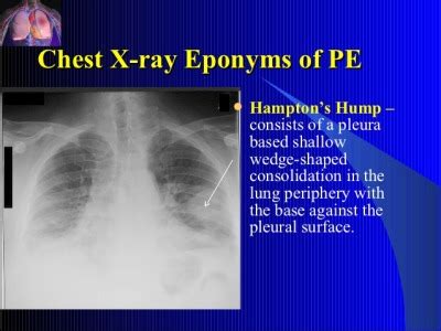 CXR In Pulmonary Embolism MC Presentation Normal Tumbex