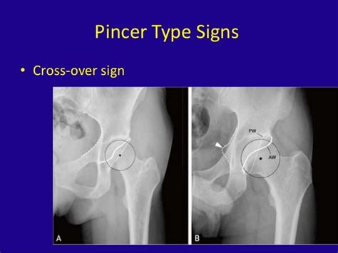 Femoroacetabular Impingement Syndrome