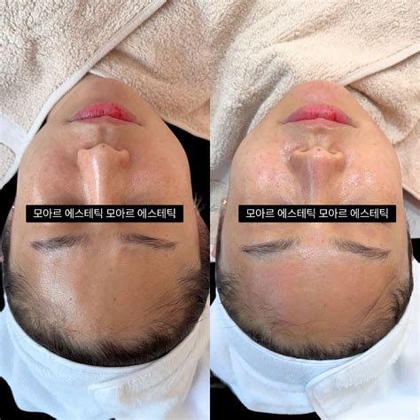 슈퍼젝션 논산 모아르” 대표 송화정 논산피부관리 대전슈퍼젝션 파메스테틱 홈케어코칭 심부볼 주목 미간 주목 심는필러 슈퍼젝션 블루 1회 전 후