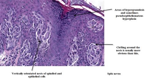 Dermpath Made Simple Neoplastic Spitz Nevus And Reed Nevus