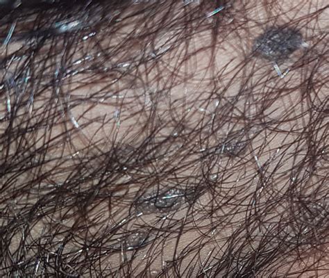 Ask A Urologist Online For Genital Warts Or Skin Tags