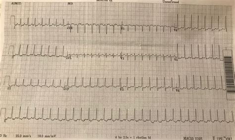 EKG Of The Week 2019 7 14 Staten Island University Hospital Emergency Medicine