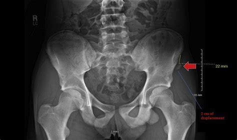 Asis Avulsion Fracture Repair With Lag Screw And Tape Bridge Construct